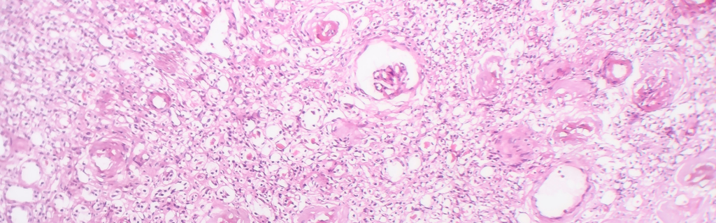 Understanding Immunoglobulin A Nephropathy (IgAN) – AAKP