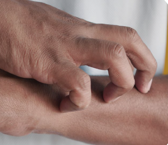 To Itch or Not To Itch…That Is the Question – AAKP